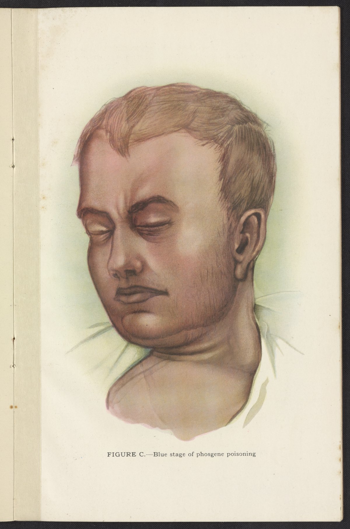 Figure C.—Blue stage of phosgene poisoning. - Science History Institute ...