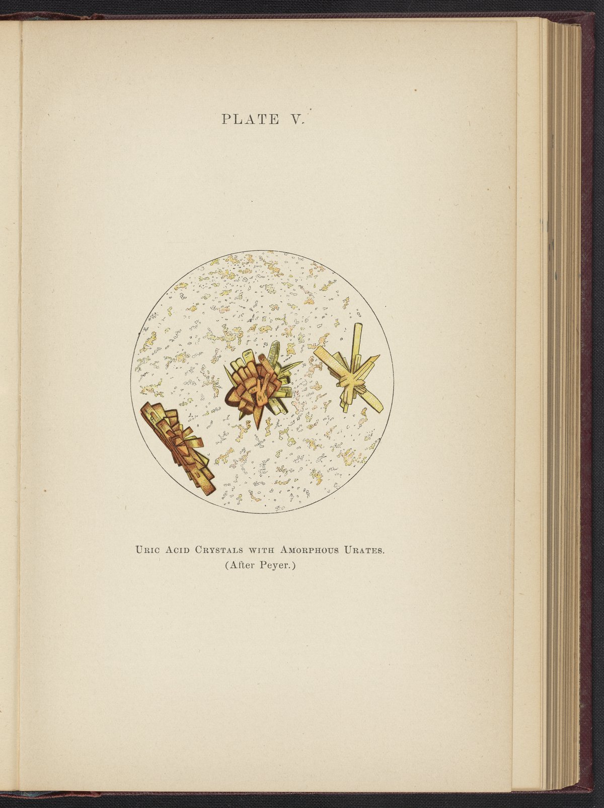 Plate V: Uric Acid Crystals with Amorphous Urates - Science History ...